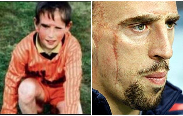Ribery tells emotional story of growing up with facial scars